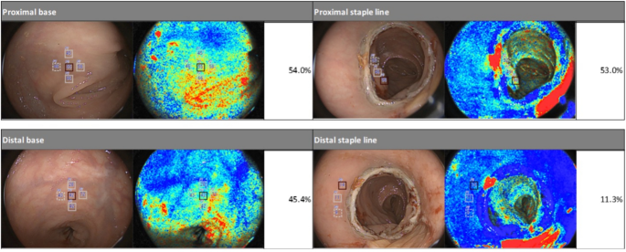 Real-time bowel perfusion monitoring with FUJIFILM ELUXEO® VISION ...