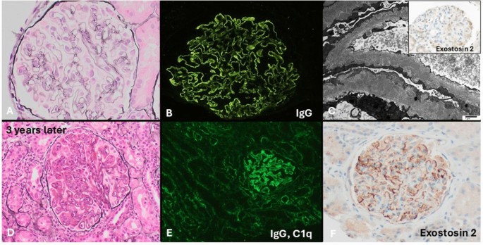 EXT2 transition in adolescent membranous nephritis | Pediatric Nephrology