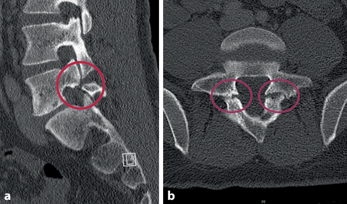 Spondylolisthese | Der Schmerz