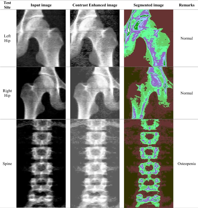 Expeditious detection and segmentation of bone mass variation in DEXA ...