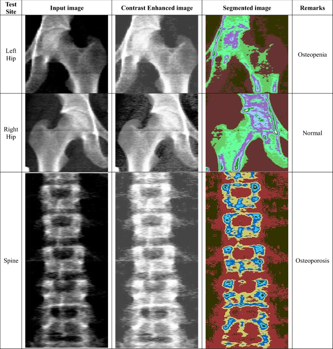Expeditious detection and segmentation of bone mass variation in DEXA images using the hybrid ...