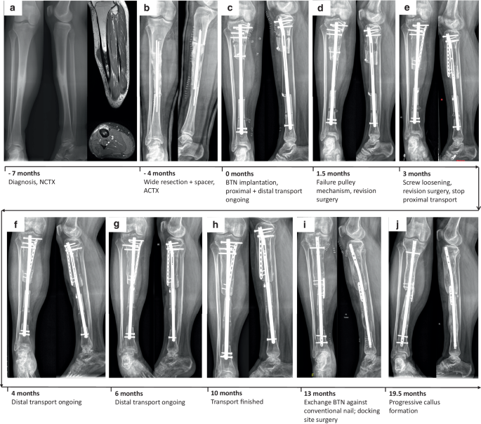 Bone transport nails for reconstruction of lower limb diaphyseal ...