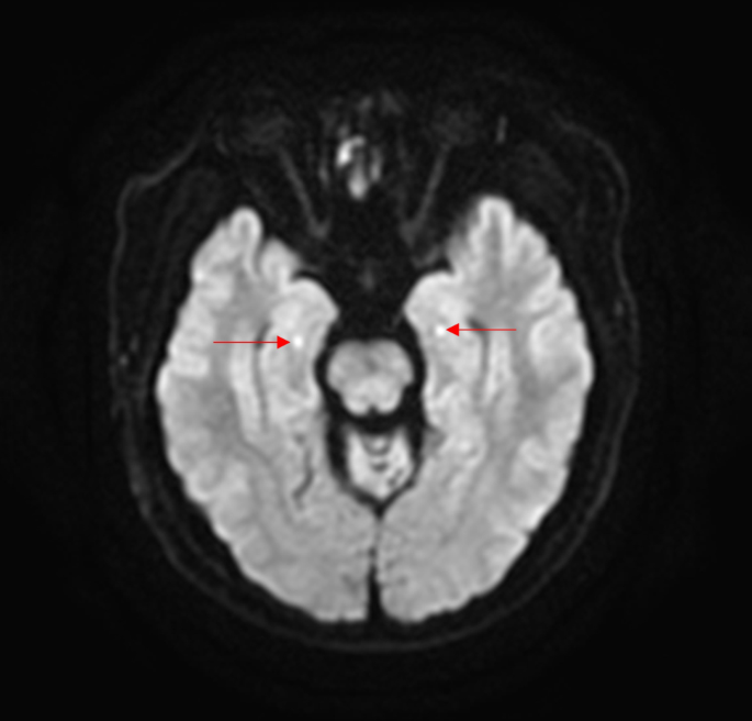 Transient global amnesia with bilateral punctate hippocampal ...
