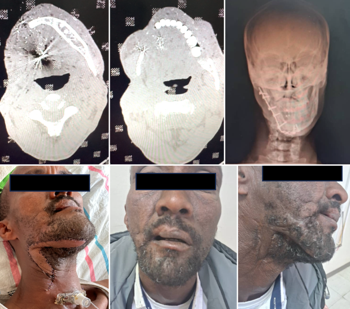 Free fibula flap for secondary mandibular reconstruction after gunshot ...