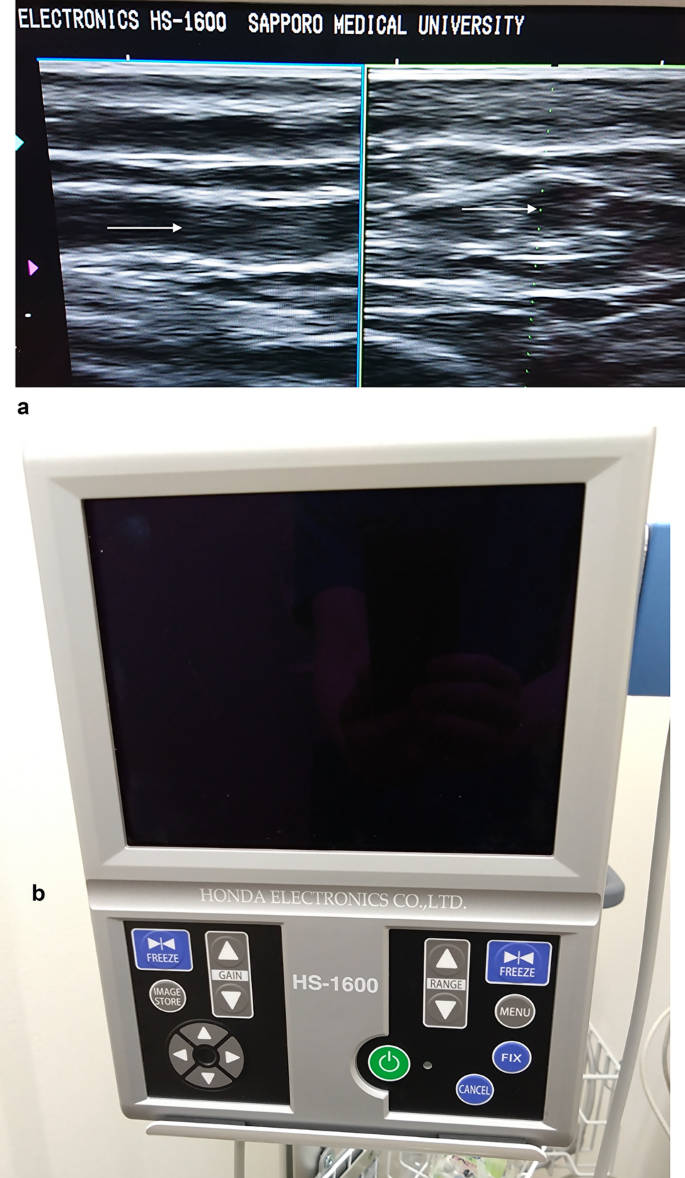 Radial artery catheterization using a novel T-type ultrasound probe: a ...
