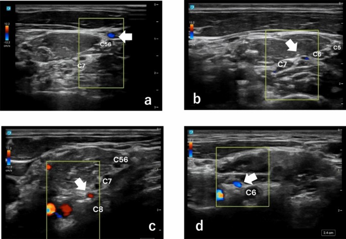 Ultrasound assessment of the frequency and variation of arteries in the ...