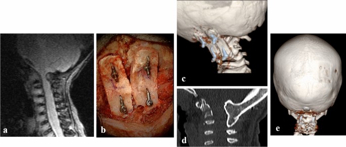 Calvarial bone graft for craniovertebral junction fixation in children ...