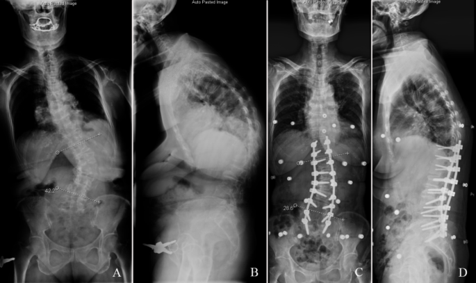 Impact of postoperative spinal malalignment on postoperative health ...