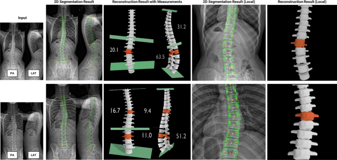 Validity of a fast automated 3d spine reconstruction measurements for ...