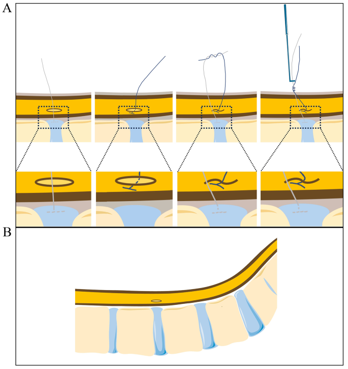 Endoscopic double line suture repair technique for repairing Iatrogenic ...