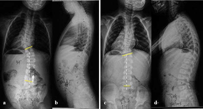 Presence of compensatory curve predicts postoperative curve progression ...