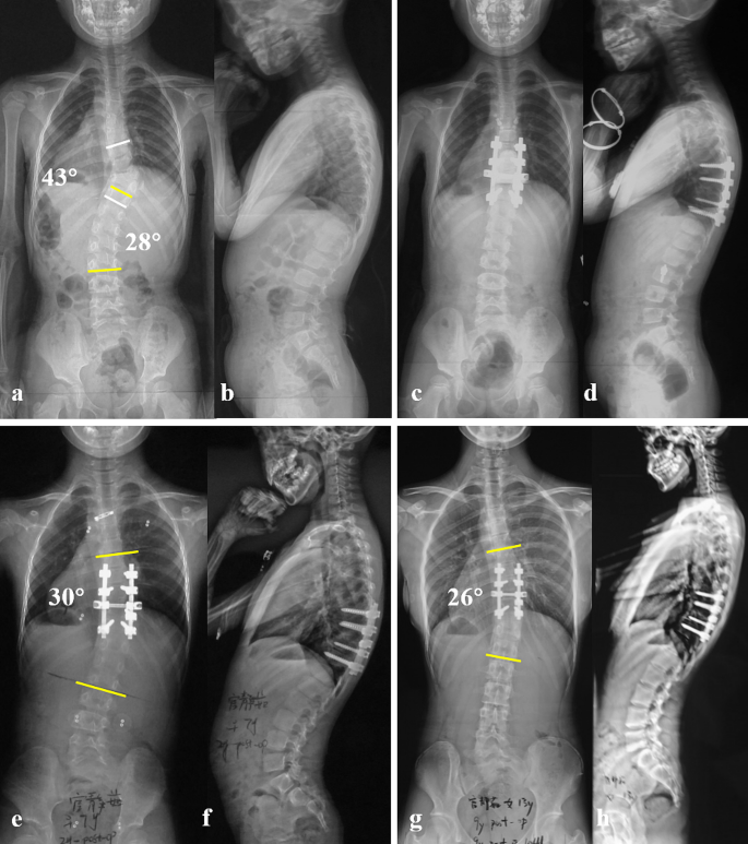 Presence of compensatory curve predicts postoperative curve progression ...