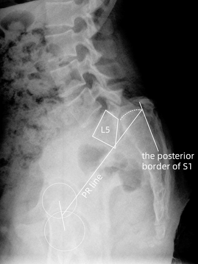 Evaluation of the effectiveness of the femoro-sacral posterior angle ...