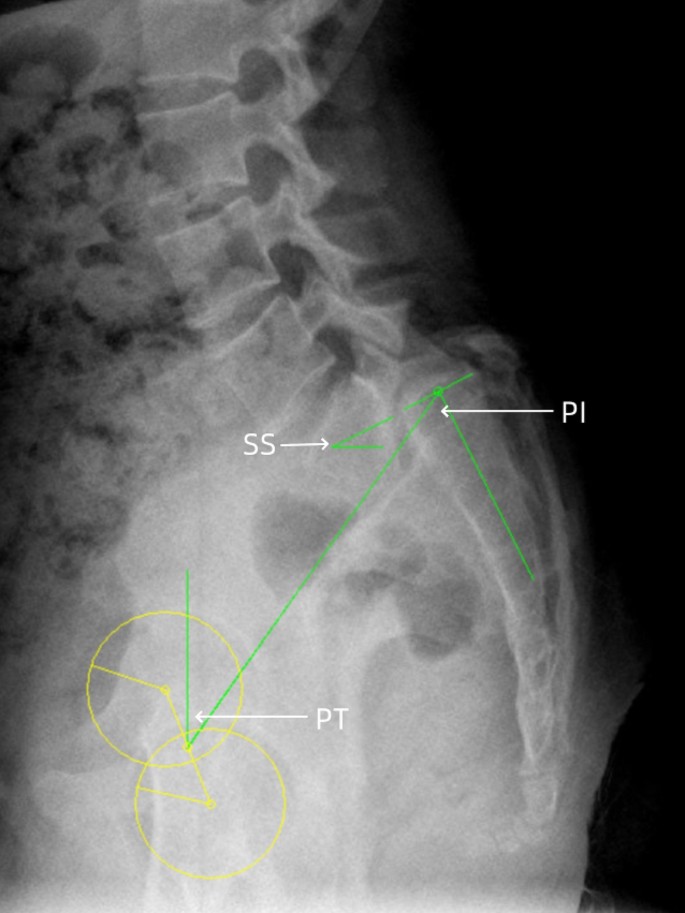 Evaluation of the effectiveness of the femoro-sacral posterior angle ...