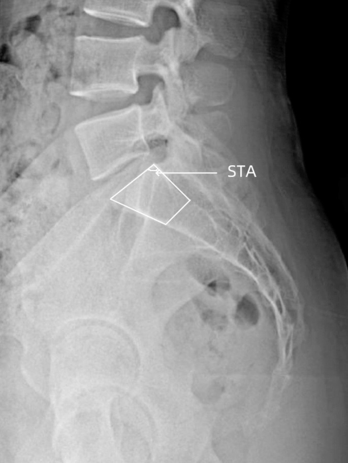 Evaluation of the effectiveness of the femoro-sacral posterior angle ...