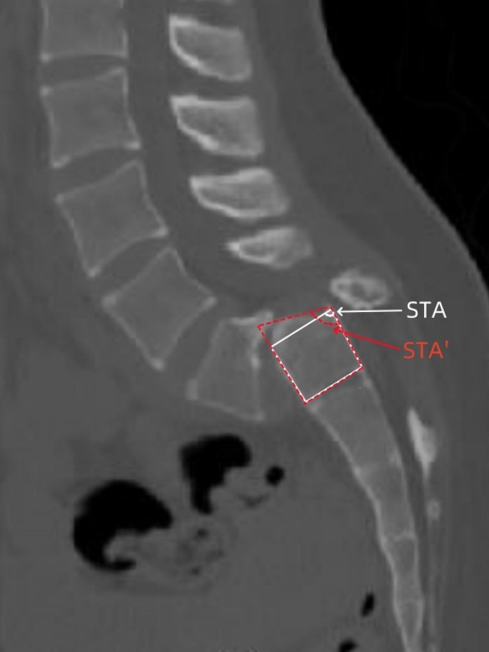 Evaluation of the effectiveness of the femoro-sacral posterior angle ...