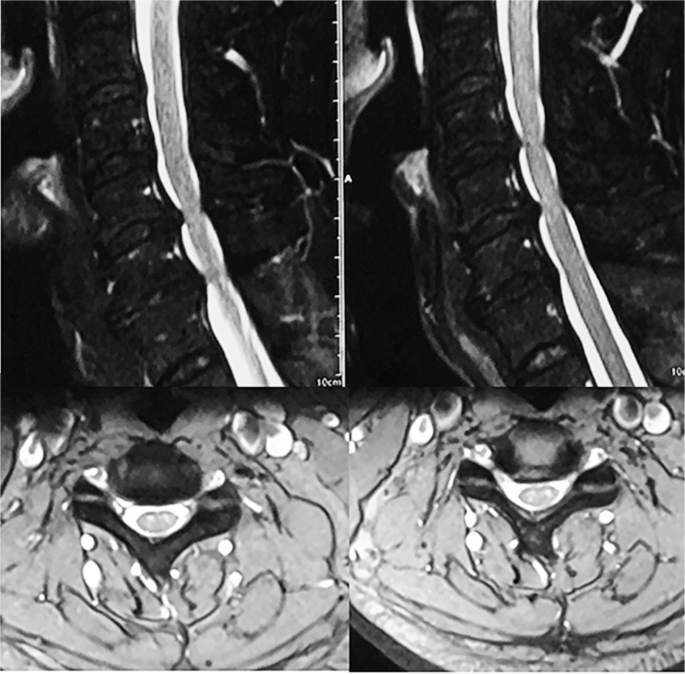 Does snake-eye appearance affect the clinical outcome of ACDF in ...