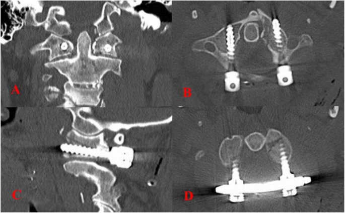 Isolated C1 arch fractures: C1-2 fusion vs. C1 osteosynthesis ...