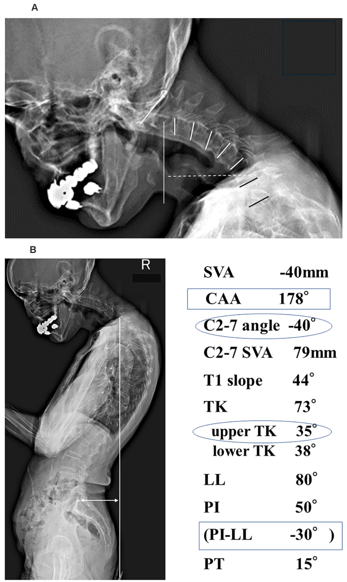 Radiological features of dropped head syndrome | European Spine Journal ...