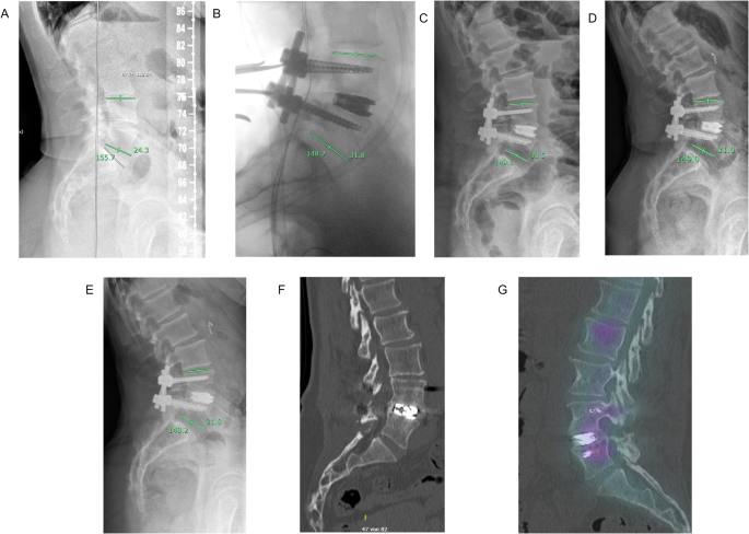 Failure of an expandable lumbar interbody spacer – a critical analysis ...