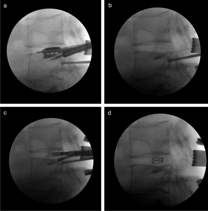 A new hernia blocking system to prevent recurrent lumbar disc ...
