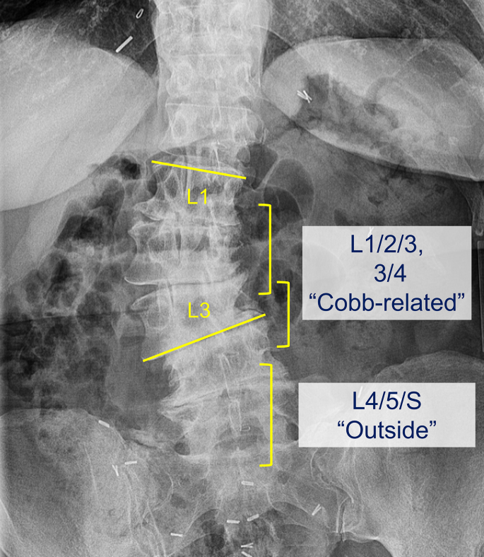 Influence of coronal lumbar Cobb angle and surgical level on short ...