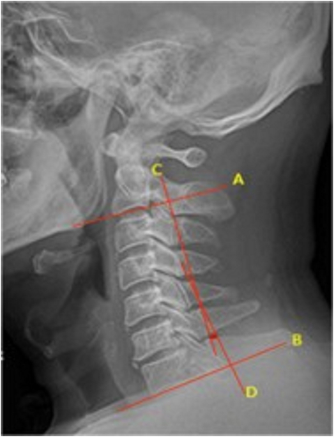The role of paraspinal muscle degeneration in cervical spondylosis ...