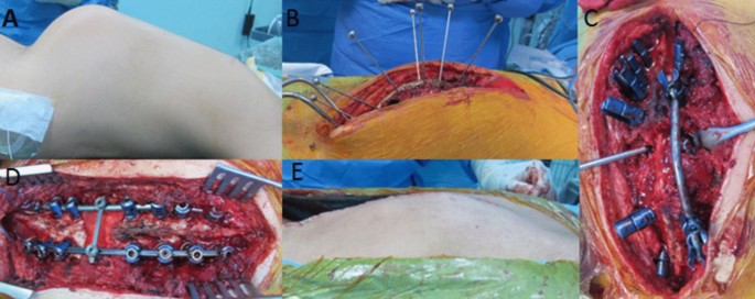 Comparison of clinical and radiological outcomes of SRS-Schwab grade 3 ...