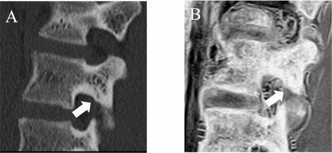 Evaluation of fracture lines in adolescent lumbar spondylolysis using ...