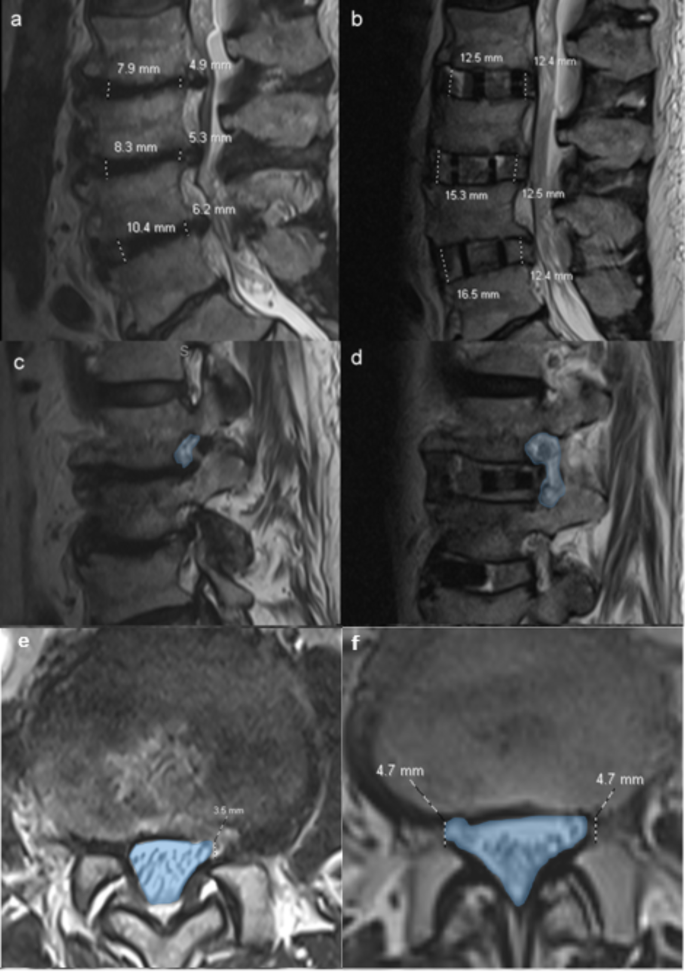Quantified MRI measurements show the significance of indirect ...