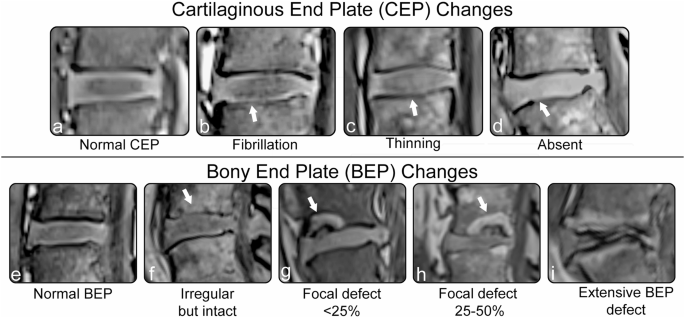 ISSLS Prize in Clinical Science 2025: Cartilage End Plate Defects ...