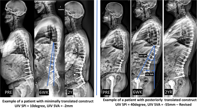 Iatrogenic posterior translation of the construct at the uppermost ...