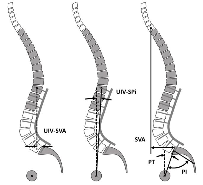Iatrogenic posterior translation of the construct at the uppermost ...