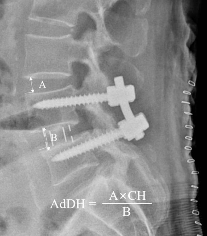 Selection of cage height in oblique lateral interbody fusion: is a cage ...