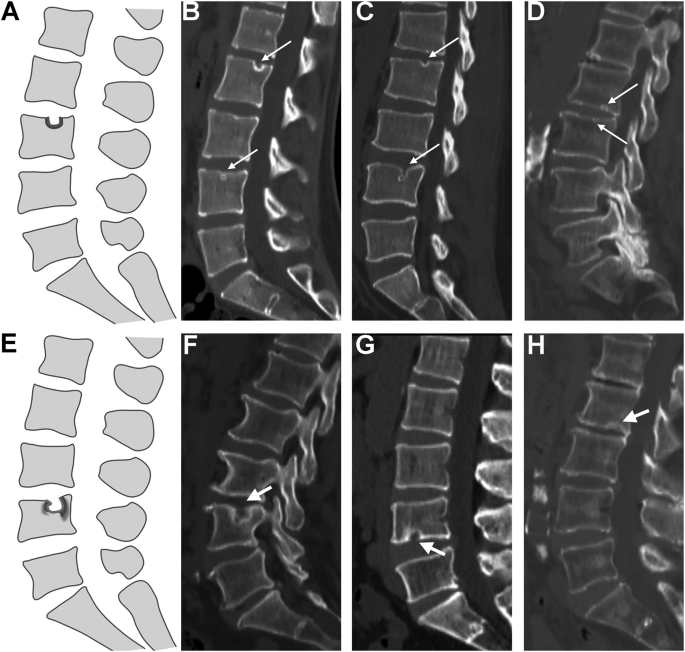 Subtype analysis of Schmorl’s nodes in the lumbar spine and the association with lumbar ...