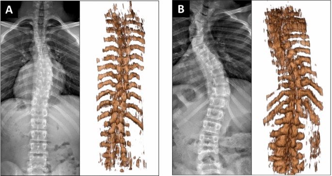 Bone-enhanced 3D ultrasound: a non-ionizing alternative for pediatric ...