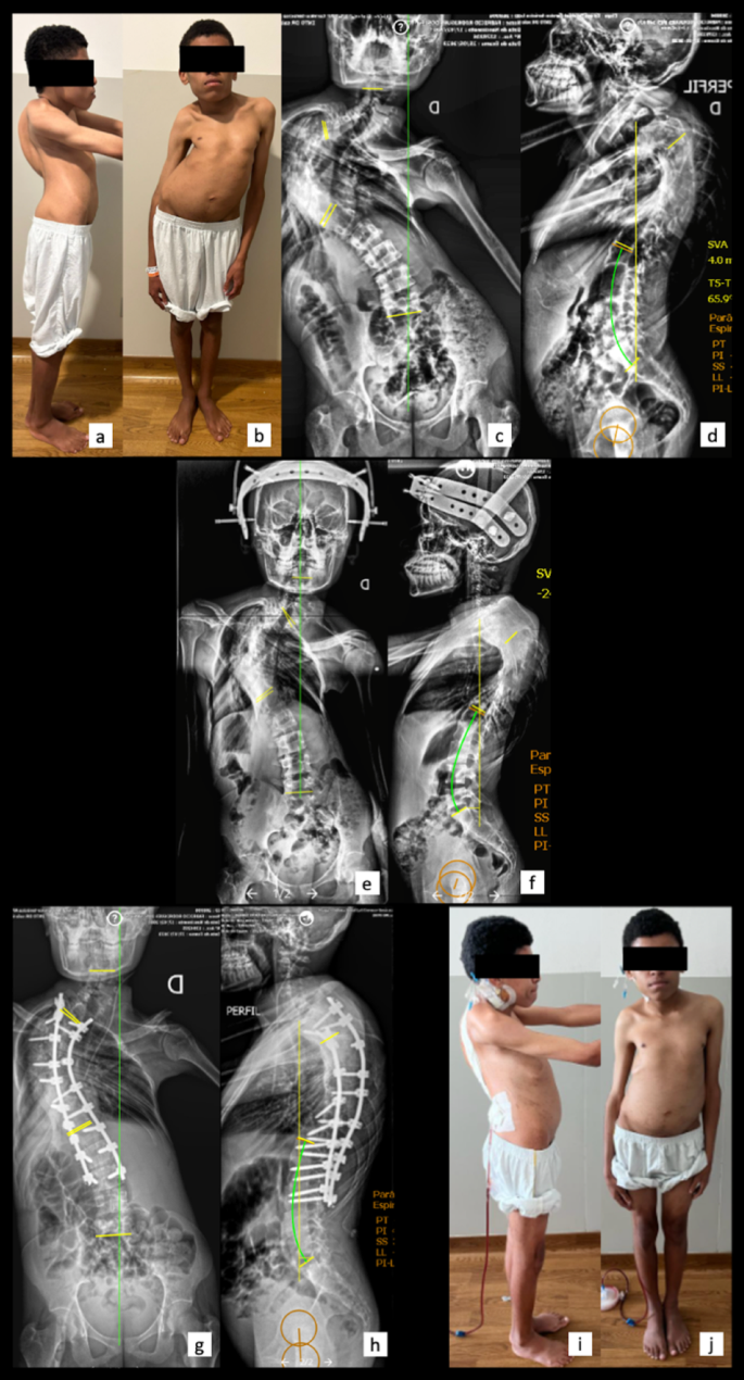 Beyond the Cobb angle: the radiographic measurement differences from halo gravity traction in ...
