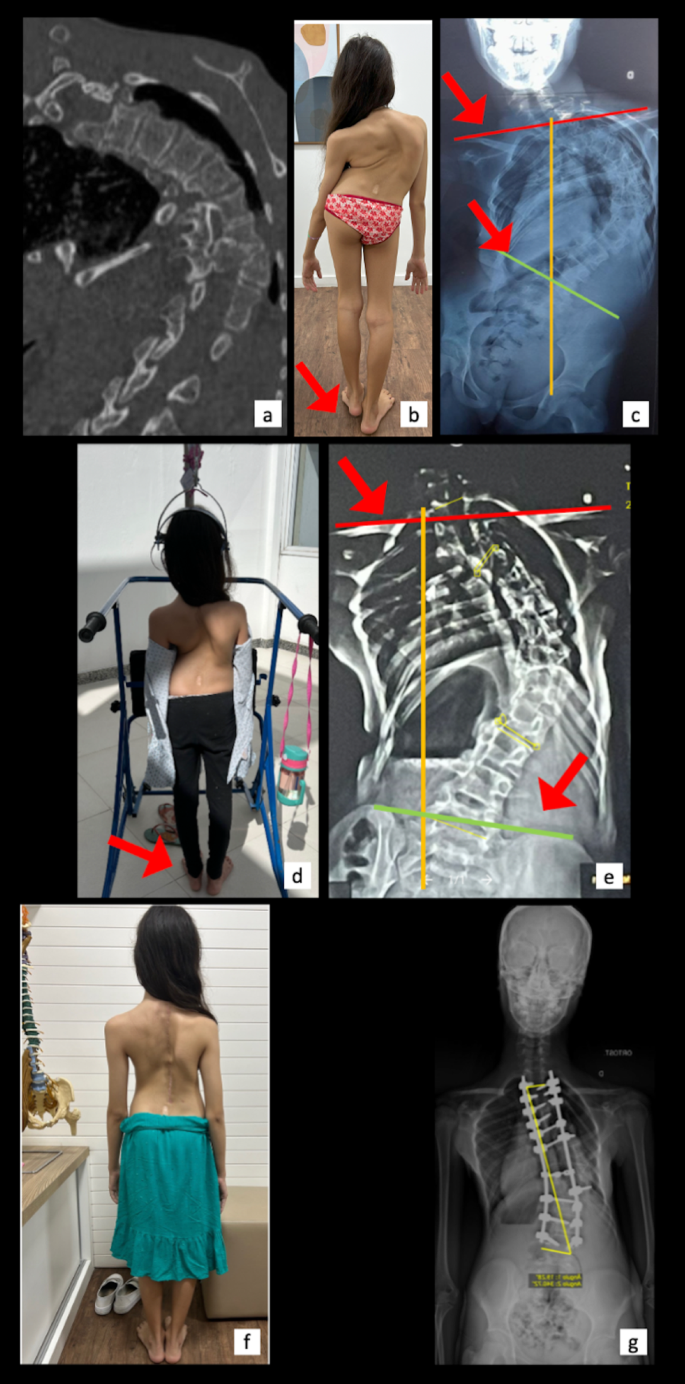 Beyond the Cobb angle: the radiographic measurement differences from halo gravity traction in ...
