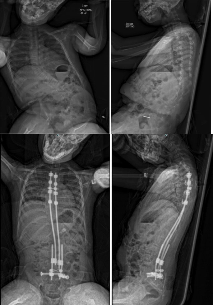 Bipolar spinal correction reduces transfusion rate and hospital stay ...