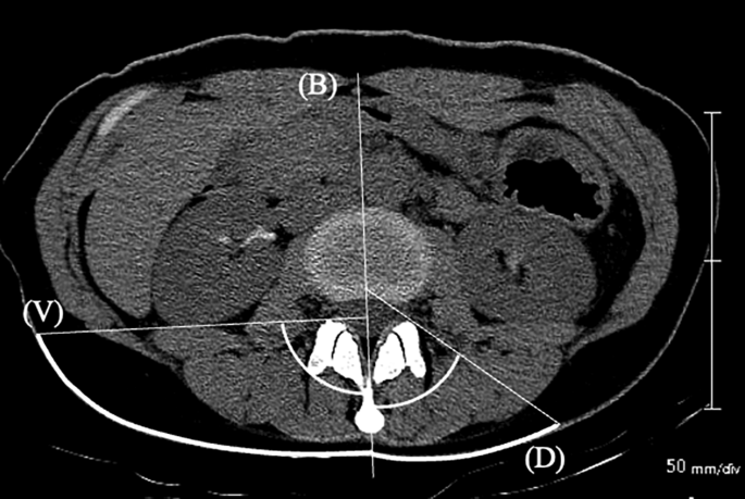 Approach-related safety considerations for transforaminal full ...