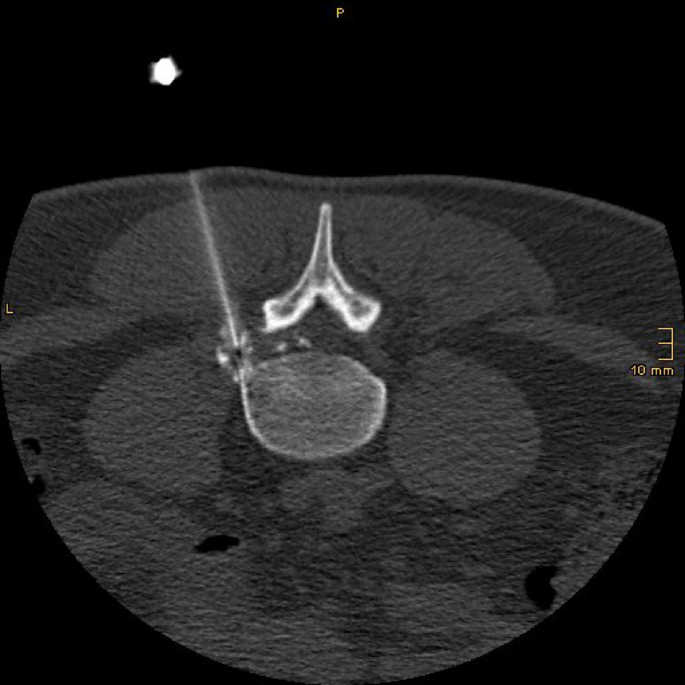 Volumetric measurement of herniated disc material as a predictor of ...