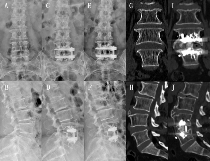 Comparison of oblique lumbar interbody fusion with pedicle screw ...