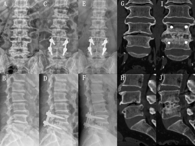 Comparison of oblique lumbar interbody fusion with pedicle screw ...