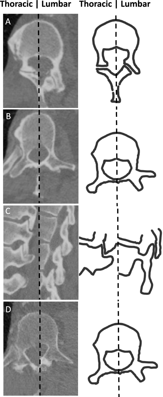 A vertebral shape-based classification for labeling the thoracolumbar ...