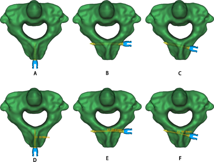 Three-dimensional quantitative CT analysis of the C2 spinous process ...