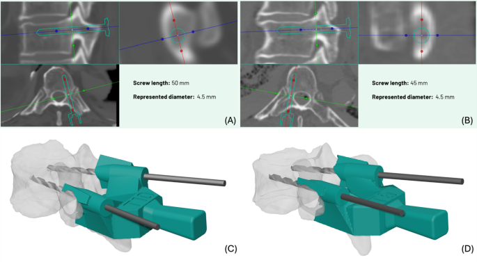 CT vs. MRI-based synthetic CT: accuracy of thoracic and lumbar pedicle ...