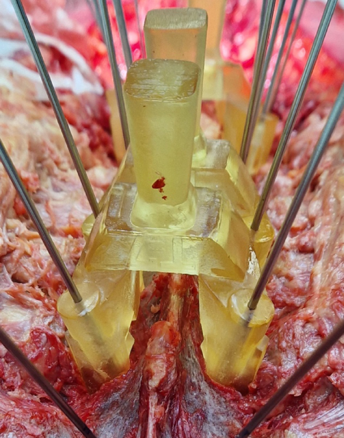 CT vs. MRI-based synthetic CT: accuracy of thoracic and lumbar pedicle ...