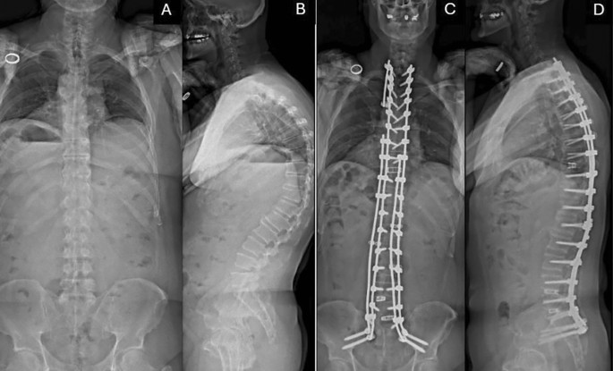 Return to Golf after corrective surgery in adult spinal deformity ...