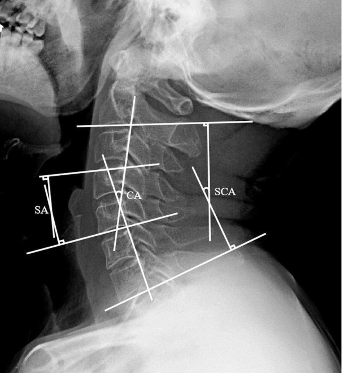 Bone tunnel approach for cervical spondylotic radiculopathy with ...