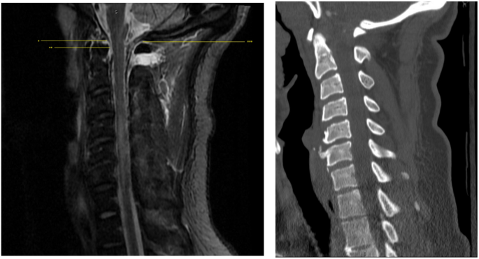 Atlanto Occipital Dislocation Radiology ECR 2010 / C 2863 / Paediatric